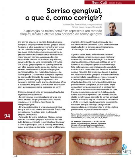 Cult Sorriso gengival O que é como corrigir Primer Odontocenter