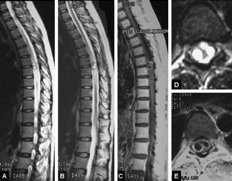Intramedullary Spinal Cysticercosis Mri Sagittal T2wi A And B And