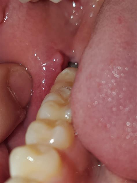 Does This Look Like Dry Socket R Wisdomteeth