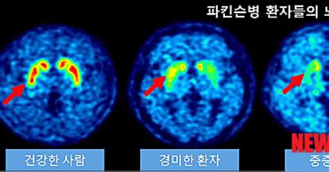 부산 파킨슨 조기진단용 방사성의약품 본격 출시
