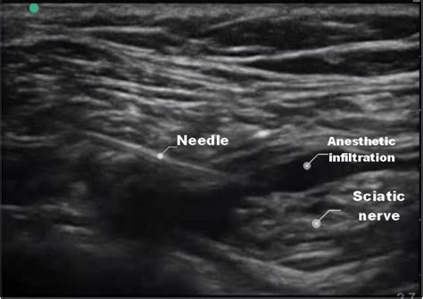 Sciatic Nerve Block