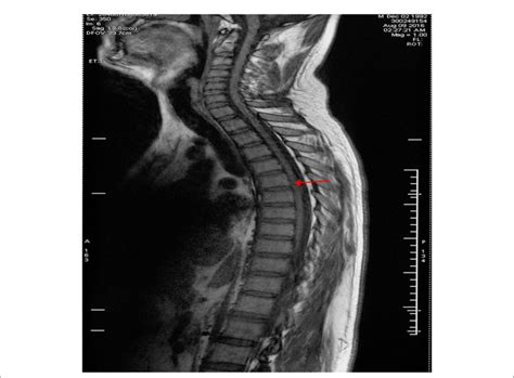 Figure Thoracic Spinal Mri Image In The Proband Thoracic Spinal Mri