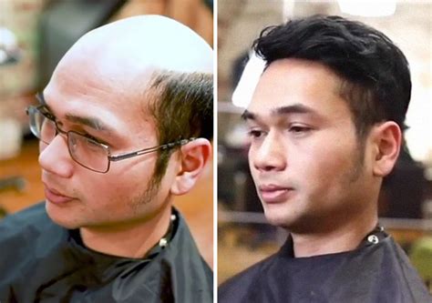 Balding Guys Try Out Non Surgical Hair Replacements By Phil Ring And