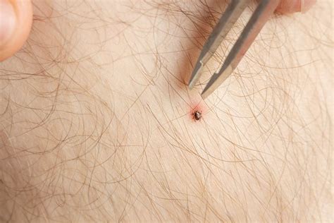 what does a tick bite look like before the bullseye