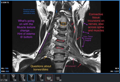 Coronal Mri Regarding Upper Arm Spasticity Involuntary Movements