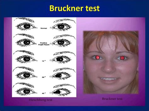 Amblyopia Classification Squintppt Classification Of Ambylopia Ppt Ppt