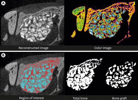 Radiographic Analysis Micro Ct A Reconstructed Image Of Micro Ct