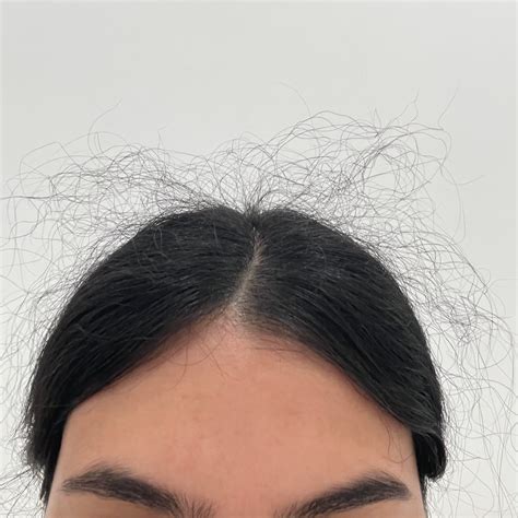 Aftermath Of Telogen Effluvium 🤣 Rfemalehairloss