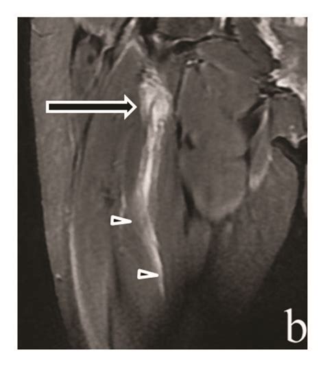 Mr Imaging Of The Right Thigh A Coronal T1 Weighted Image Shows An