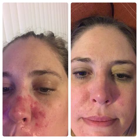 1 Week On Doxycycline And Medicated Face Wash The First Picture Isnt Even My Worst I Was So
