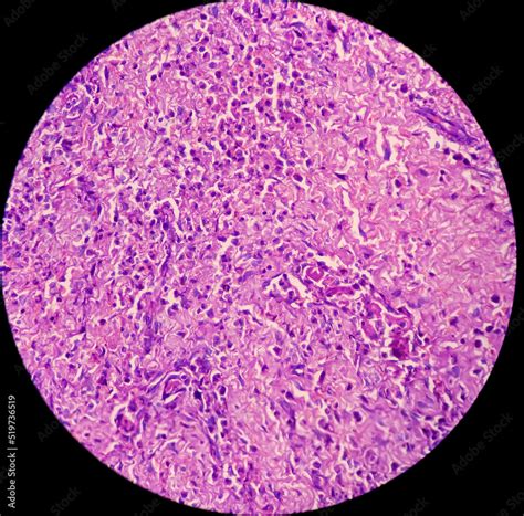 Gartners Duct Cystbiopsy Microscopic Image Show Cyst Wall Composed