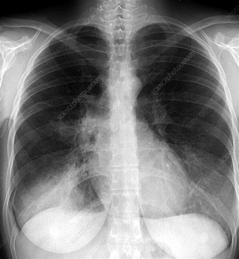 Chest Infection Symptoms And Prevention Asian Plus Samakhusi
