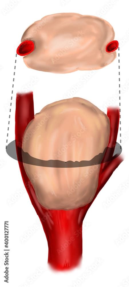 Carotid Body Tumor Iis Rare Paraganglioma Presented With Neck Mass This Demonstareted Shamblin