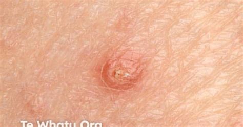 Generalised Eruptive Keratoacanthoma Image