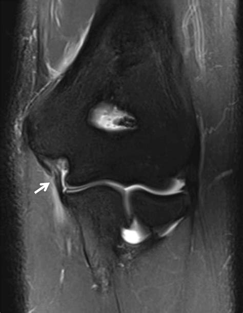 Coronal T2 Mr Arthrogram Of The Elbow Demonstrates A High Grade Partial Coronal T2 Mr Arthrogram Of The Elbow Demonstrates A High Grade Partial