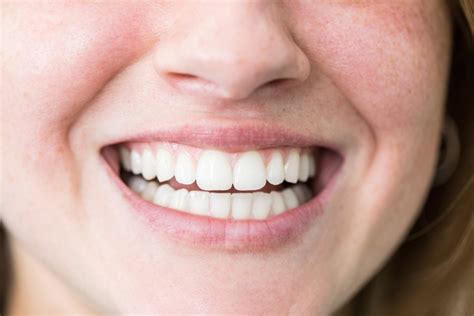 Alimentos Para Evitar El Sangrado De Encías Y Tener Buena Higiene Dental