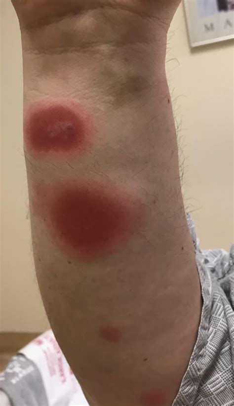 Demarcated Nonpruritic Lesions Following Antibiotic Therapy Mdedge