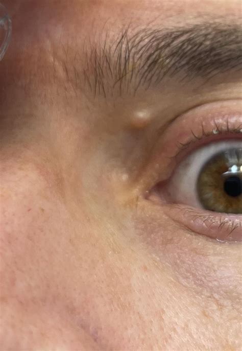 What Is This Bump On Top Of Eye Socket Rdermatologyquestions