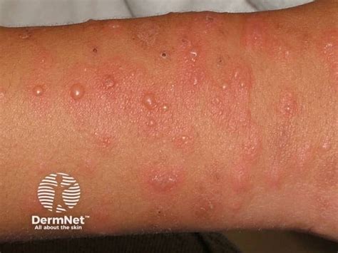Erythema Multiforme Images