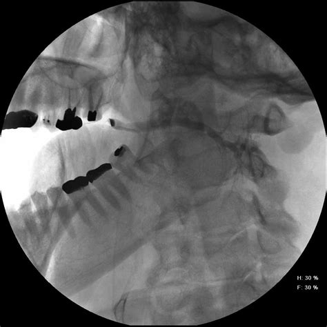 Parotid Sialogram With Sialendoscopy For Foreign Body Removal Iowa