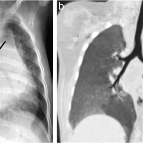Frontal Chest Radiograph A And Coronal Computed Tomography Minimum