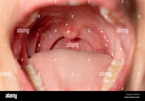 Swollen Uvula After Tonsillectomy