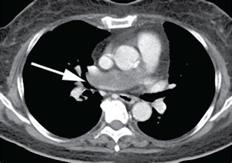 A Contrast Enhanced Computed Tomography Scan Showing A Tumor Arrow In