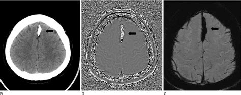Clinical Applications Of Neuroimaging With Susceptibility Weighted