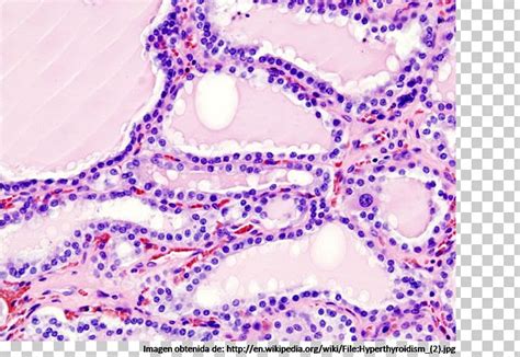 Graves Disease Hyperthyroidism Biopsy Png Clipart Autoimmunity Biopsy Cancer Dach Disease