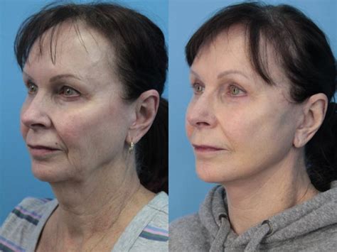 Facelift Before And After Pictures Case 408 West Des Moines And Ames