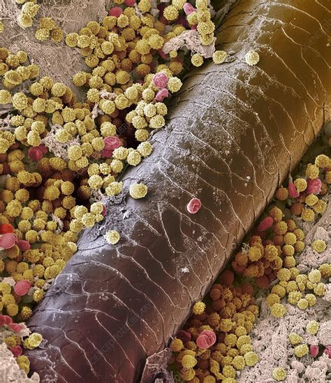 Pyoderma Skin Disease Sem Stock Image F002 7933 Science Photo