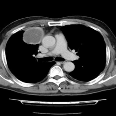 Pdf Lung Cancer Mimicking Lung Abscess Formation On Ct Images