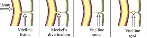 Omphalomesenteric Duct