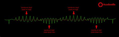 Torsades De Pointes Vs Ventricular Fibrillation