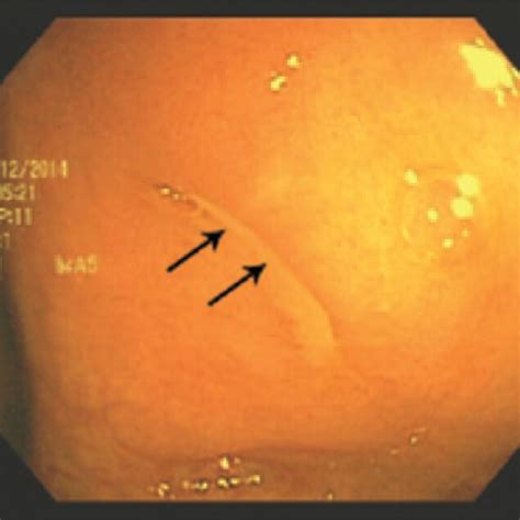 Endoscopic Picture Of The Appendiceal Orifice Showing Oozing Pus Arrow