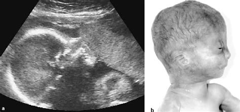 Figure 1 From Clinical Cytogenetic And Molecular Investigation In A