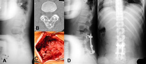 Aneurysmal Bone Cyst Spine