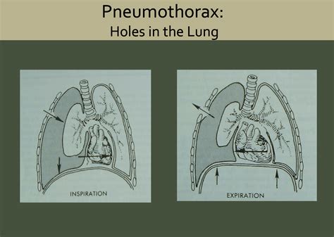 Open Pneumothorax Vs Tension Pneumothorax