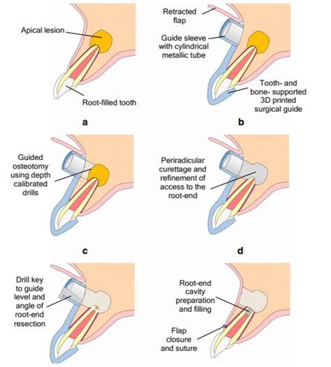 Apicoectomy Green Park Dental Hospital