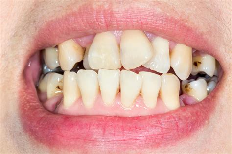 Common Kinds Of Crooked Teeth