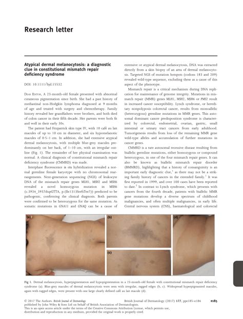 Pdf Atypical Dermal Melanocytosis A Diagnostic Clue In