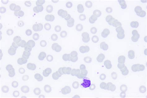 Rouleaux Formation Hematomorphology A Databank Imagebank For