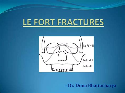 Le Fort Fracture 2 Pptx