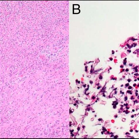 A Low Power View Of Sigmoid Colon Biopsy Showing Ulceration Arrow