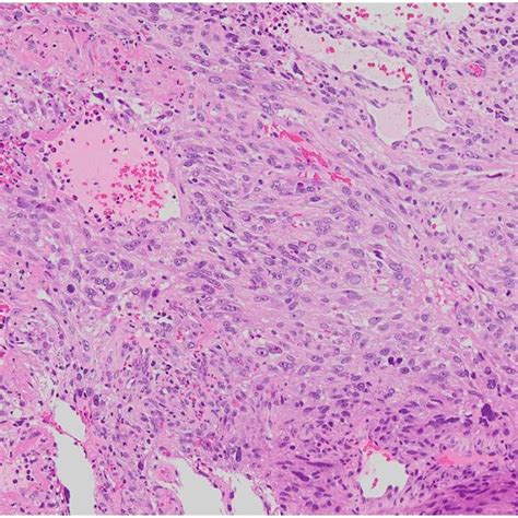 Gross Specimen Of The Endobronchial Mass After Removal Showing A Smooth