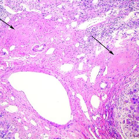 PDF Primary Sclerosing Cholangitis