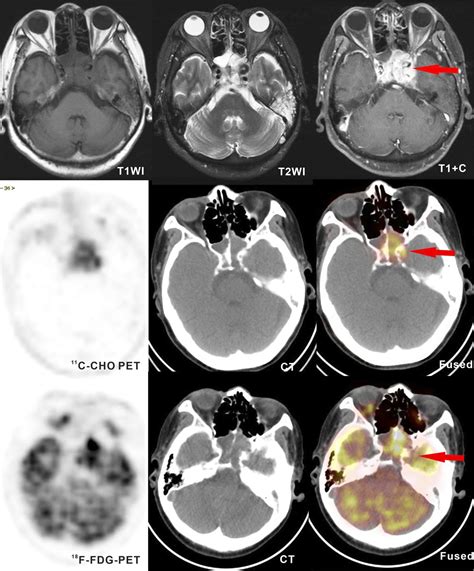 Evaluation Of C Choline PET CT For T Staging And Tumor Vol Clinical Nuclear Medicine