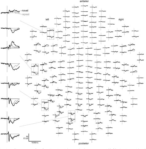 Figure 1 From Spatiotemporal Maps Of Brain Activity Underlying Word Generation And Their