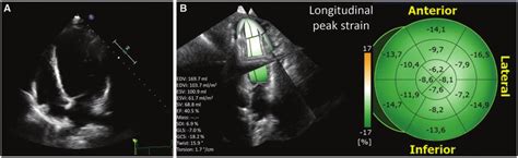 Three Dimensional Echocardiographic Speckle Tracking Analysis Tomtec