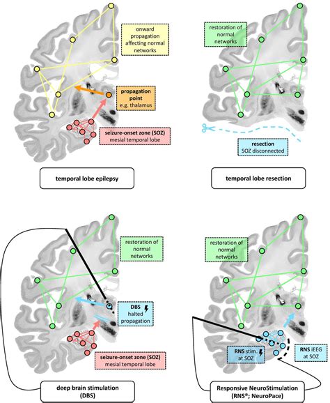 Figure 1 From Towards Network Guided Neuromodulation For Epilepsy Semantic Scholar